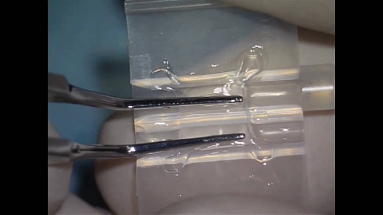 AddOn IOL - handling technique Prof. G. Sauder on Vimeo