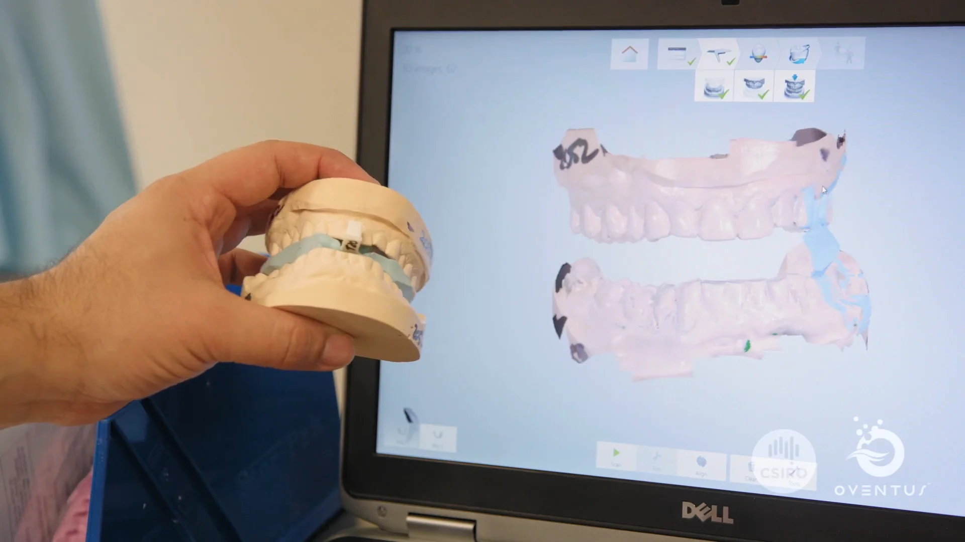 Introducing the OVENTUS O2 Vent™ Oral Appliance on Vimeo