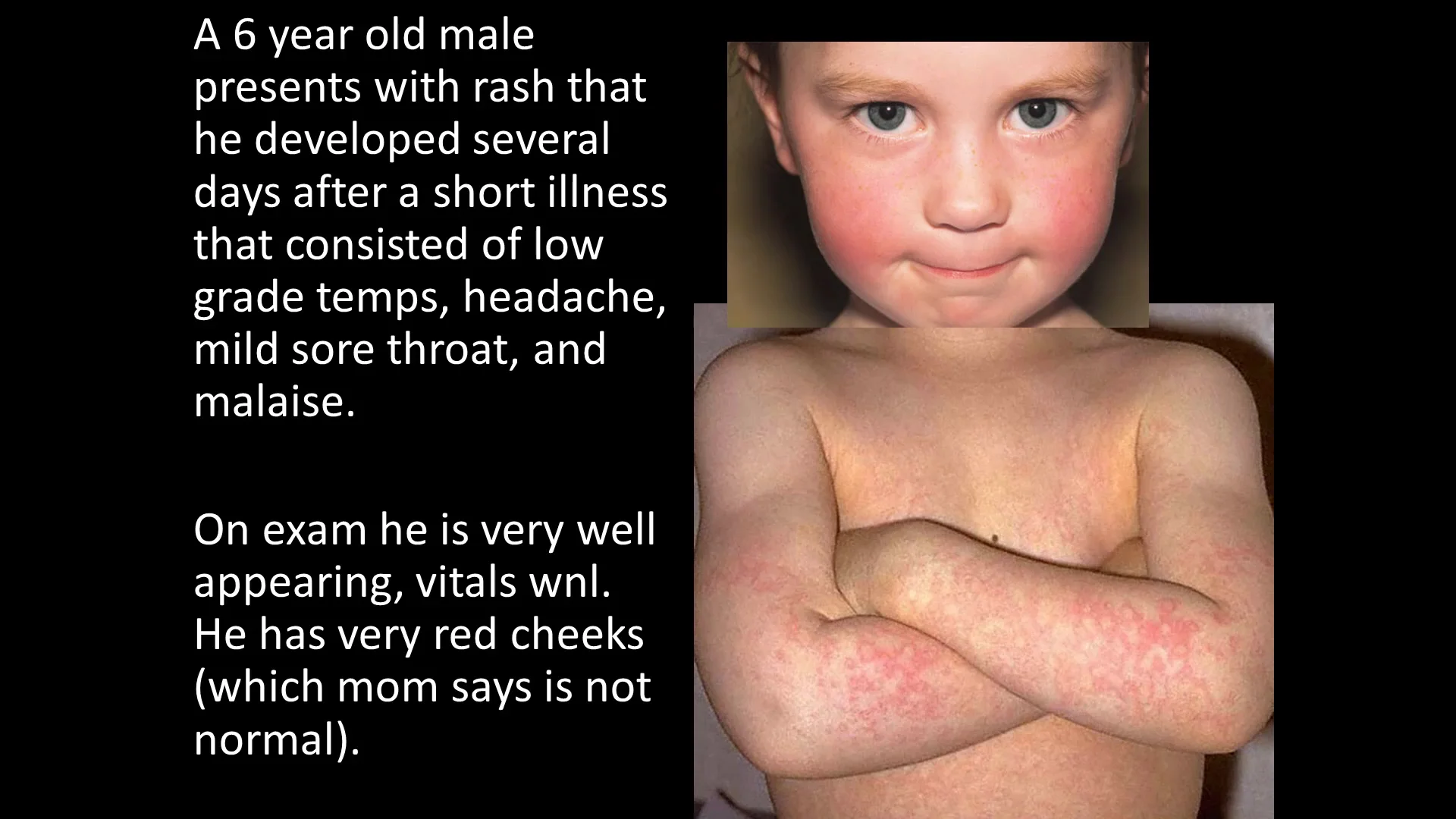 Emergency Department Pediatric Rashes