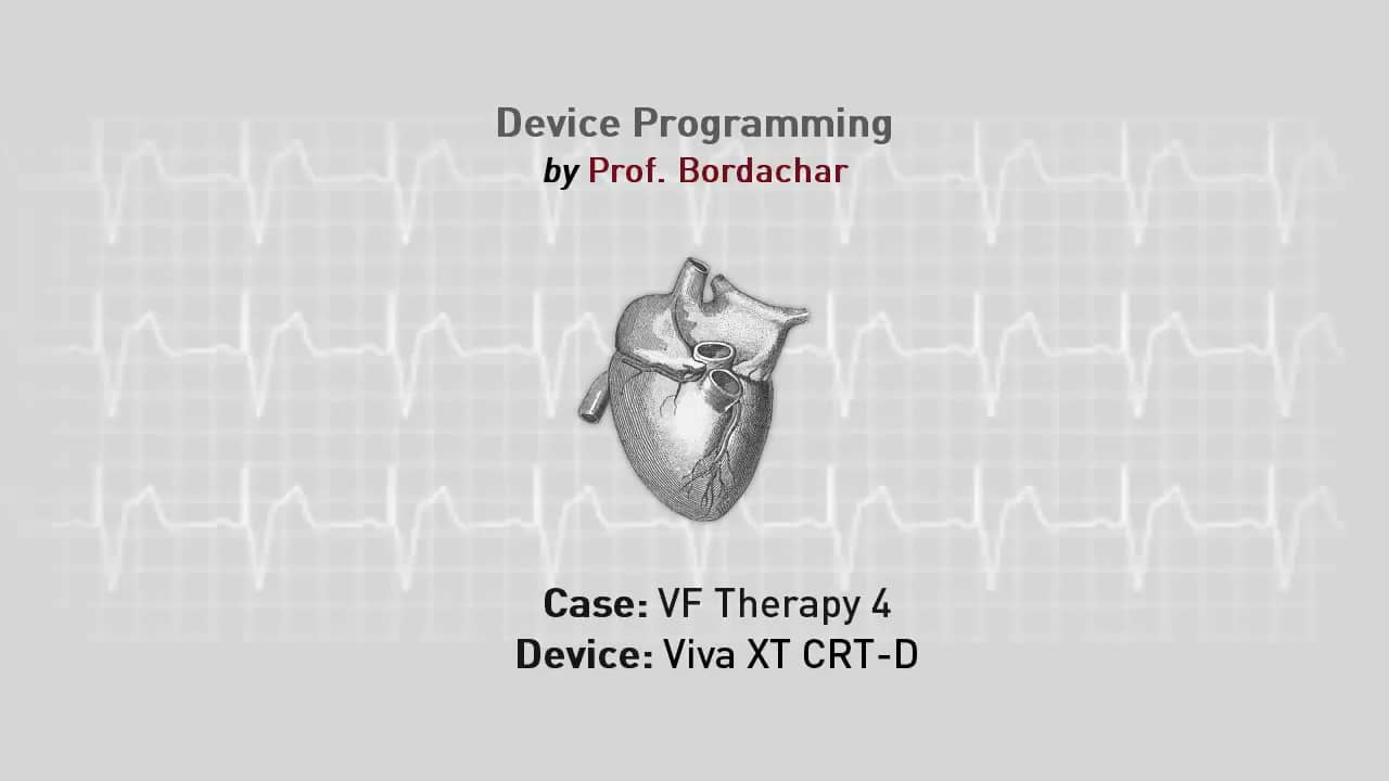 ICD | Medtronic | 3.Therapies | 1.VF shocks | VF Therapy 4 on Vimeo