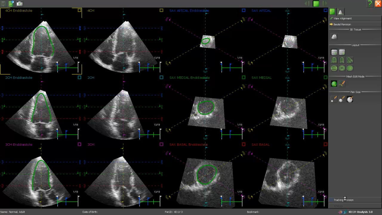 TomTec Ultrasound Cardiac Advanced on Vimeo