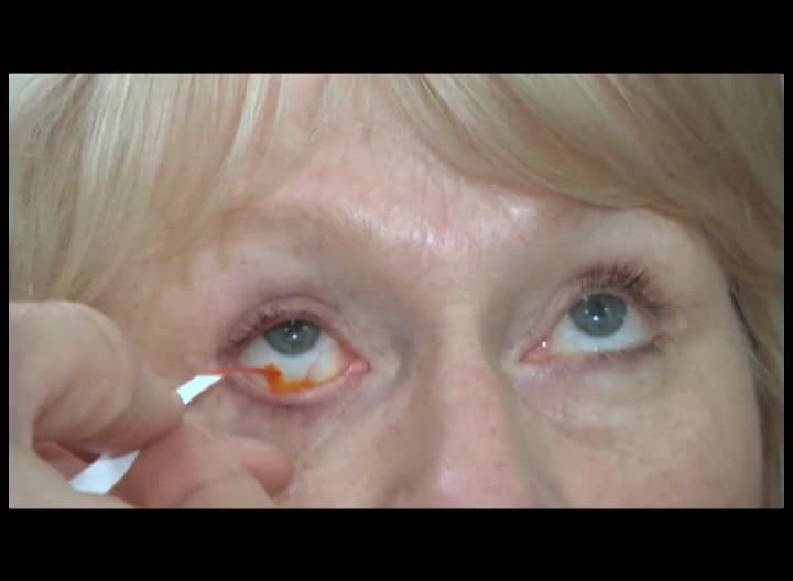 Fluorescein staining of the cornea on Vimeo