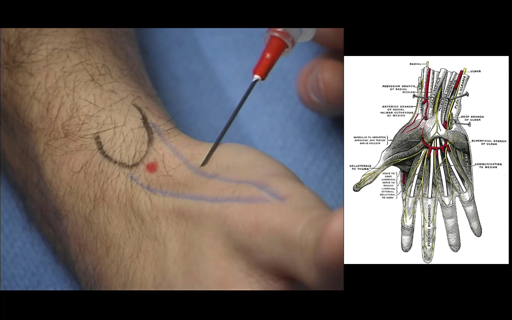 Radial Nerve Block on Vimeo