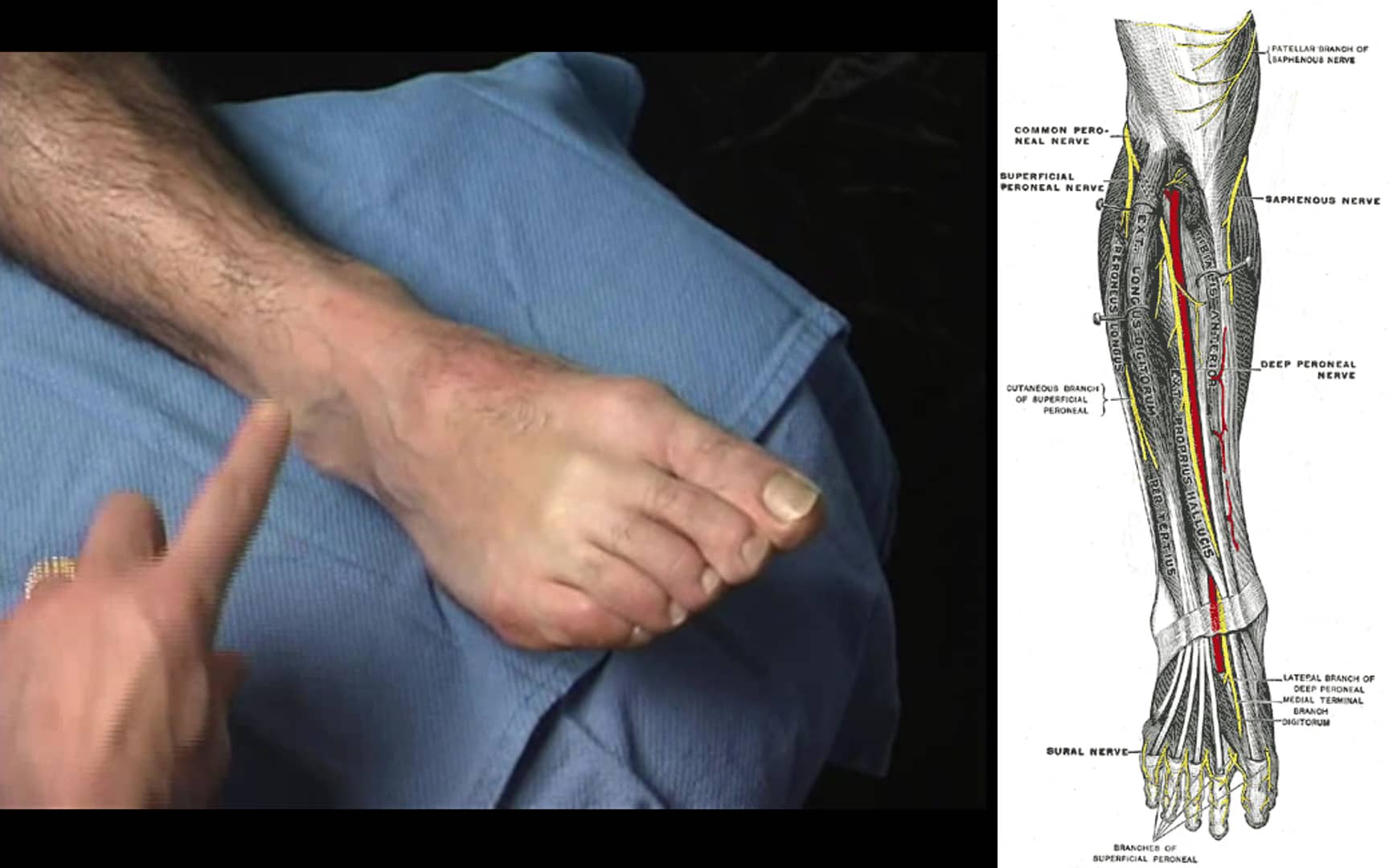 Deep Peroneal Nerve Block on Vimeo