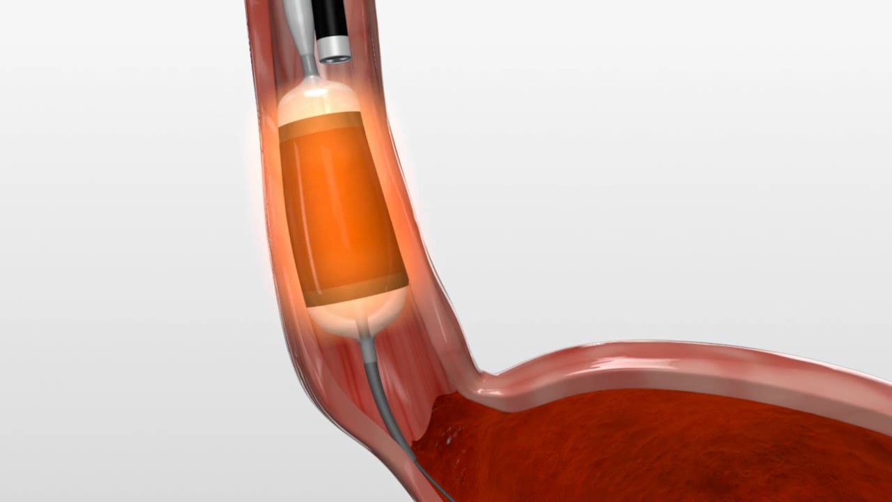 Barrx 360 RFA Balloon Catheter Animation on Vimeo