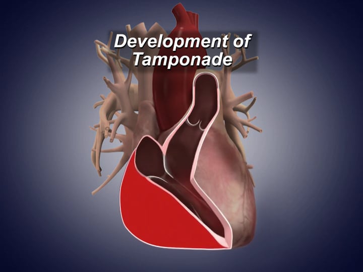 Cardiac Tamponade Animation - R18388-01Xa on Vimeo