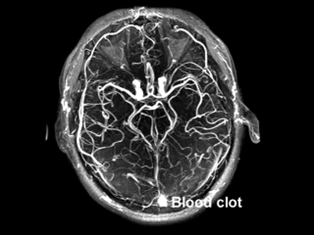 Diffusion MRI – looking at water moving — Science Learning Hub