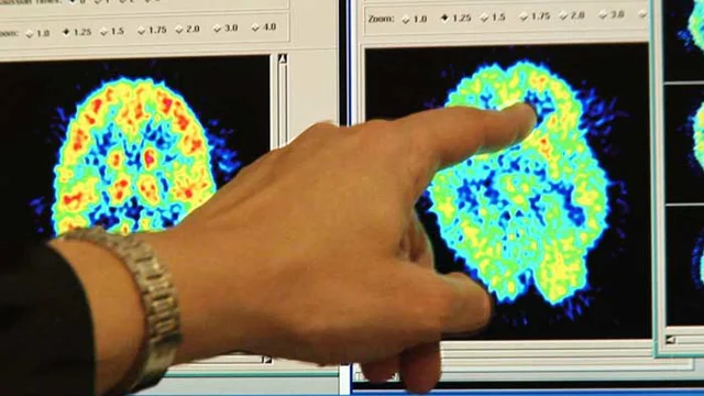 Borderline Personality Disorder Brain Vs Normal