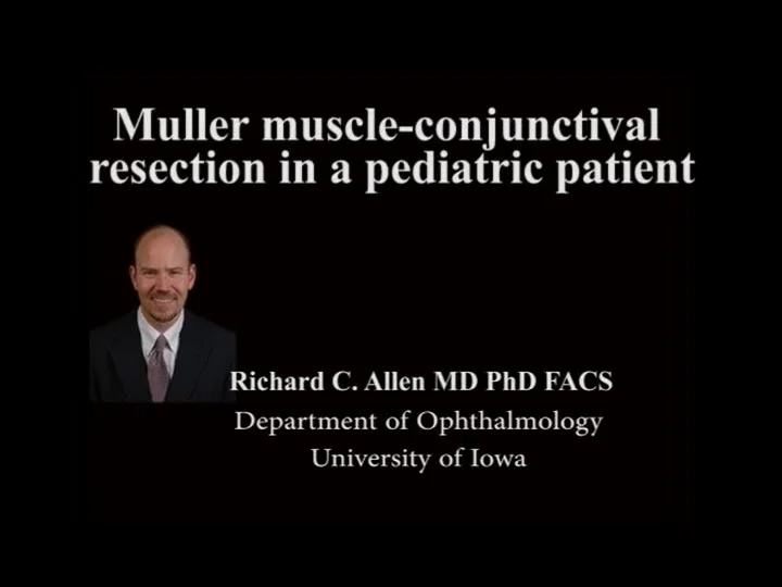 Muller muscle-conjunctival resection in a pediatric patient on Vimeo