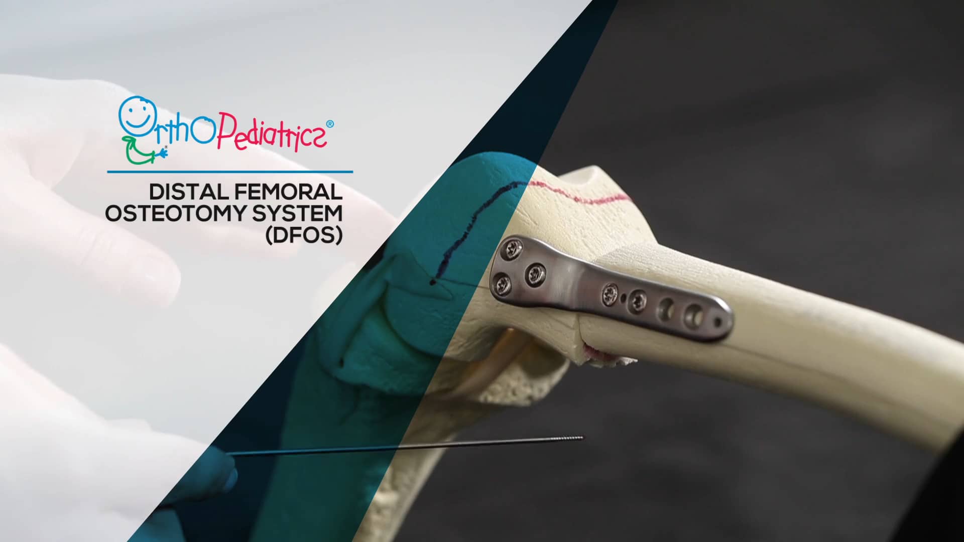 Distal Femoral Osteotomy System (DFOS) Sawbones Demonstration on Vimeo