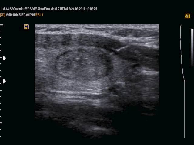 Punkcija čvora u štitnjači pod kontrolu ultrazvuka on Vimeo