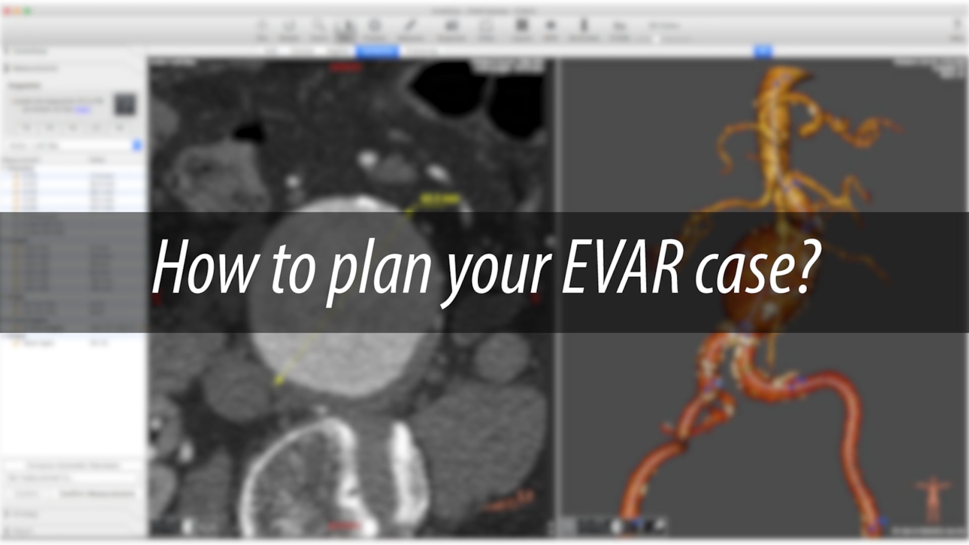 How to plan your EVAR case? on Vimeo