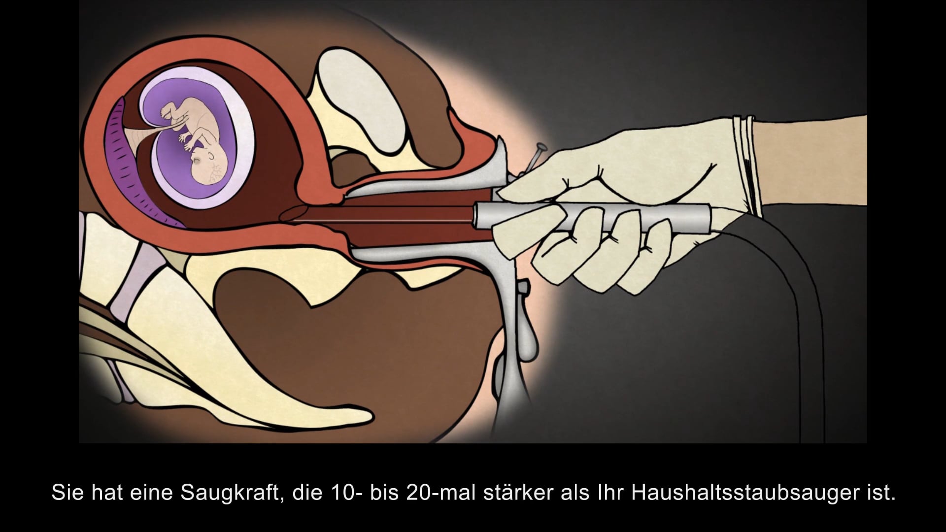 Abtreibung durch Absaugung (Vakuumaspiration) im 1. Trimester on Vimeo