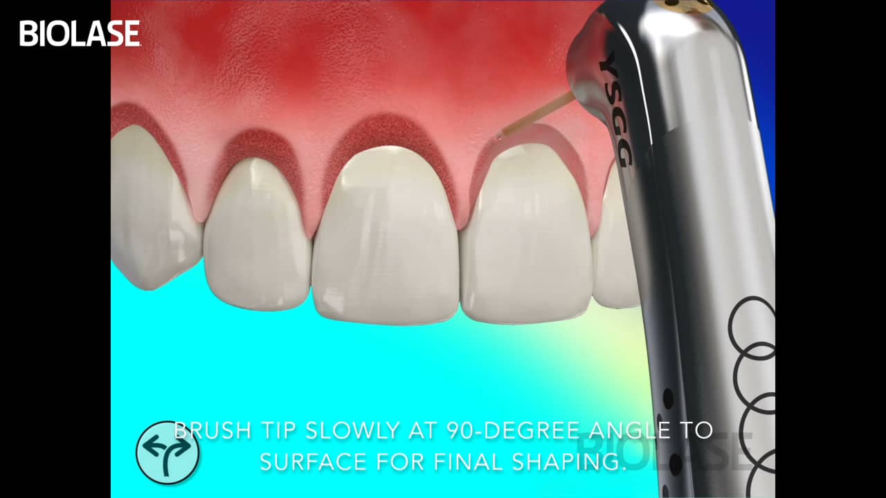 Closed-Flap Crown Lengthening on Vimeo