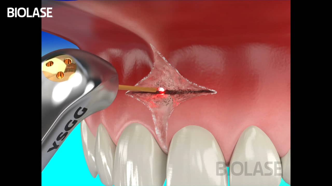 Maxillary Frenectomy with Waterlase on Vimeo