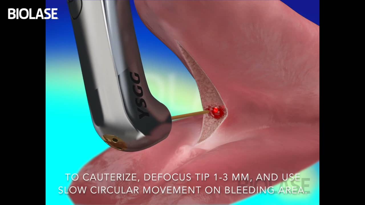 Lingual Frenectomy with Waterlase on Vimeo