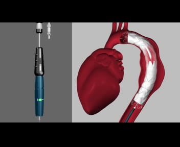 Zenith Alpha Thoracic Animation on Vimeo
