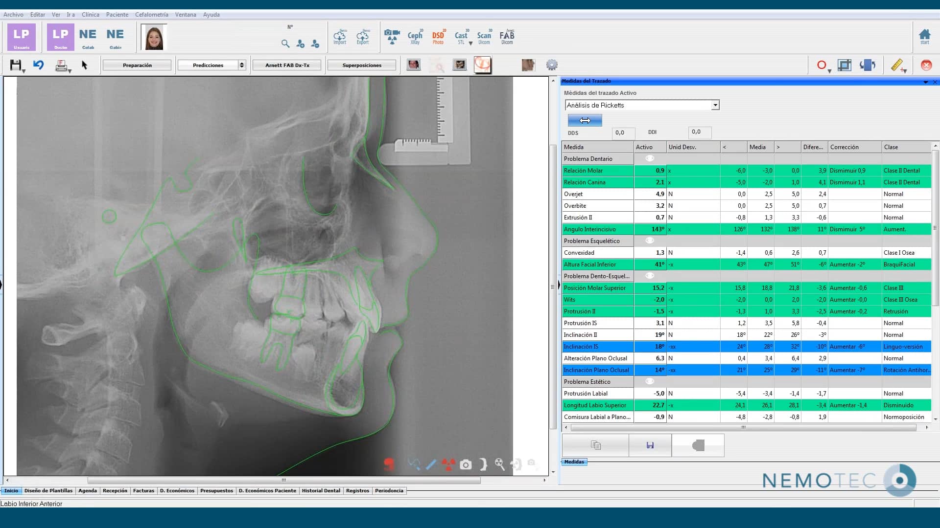 Vídeo DEMO NemoCeph Análisis Cefalométrico Versión Larga on Vimeo