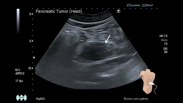 pancreatic cancer (tail) - SONO.GALLERY