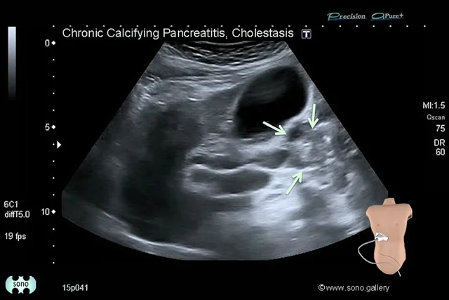 Phlegmonous Pancreatitis Ultrasound