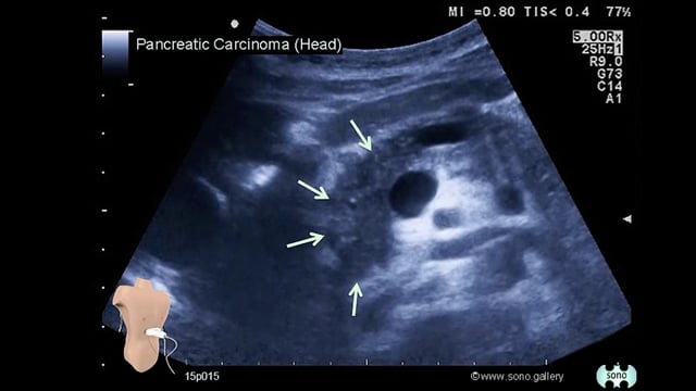 pancreatic cancer (proc. uncinatus) - SONO.GALLERY