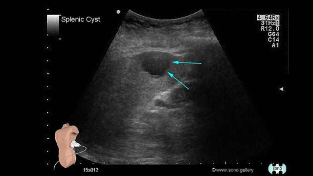 Splenic Cyst, Accessory Spleen - SONO.GALLERY
