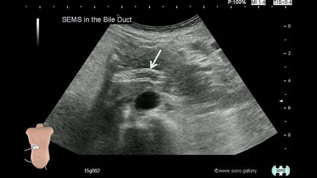 pancreatic cancer (bile duct stent) - SONO.GALLERY