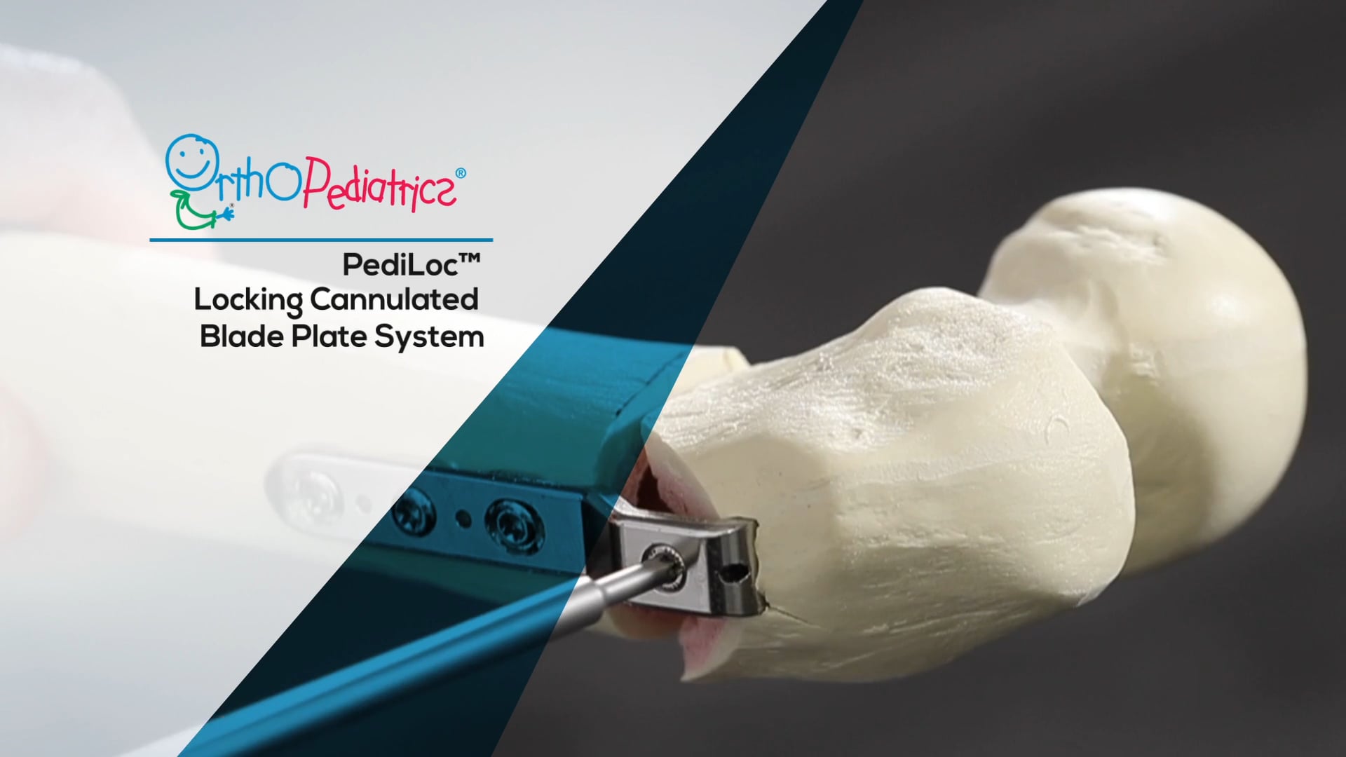 OrthoPediatrics PediLoc Locking Cannulated Blade Plate System (LCB)