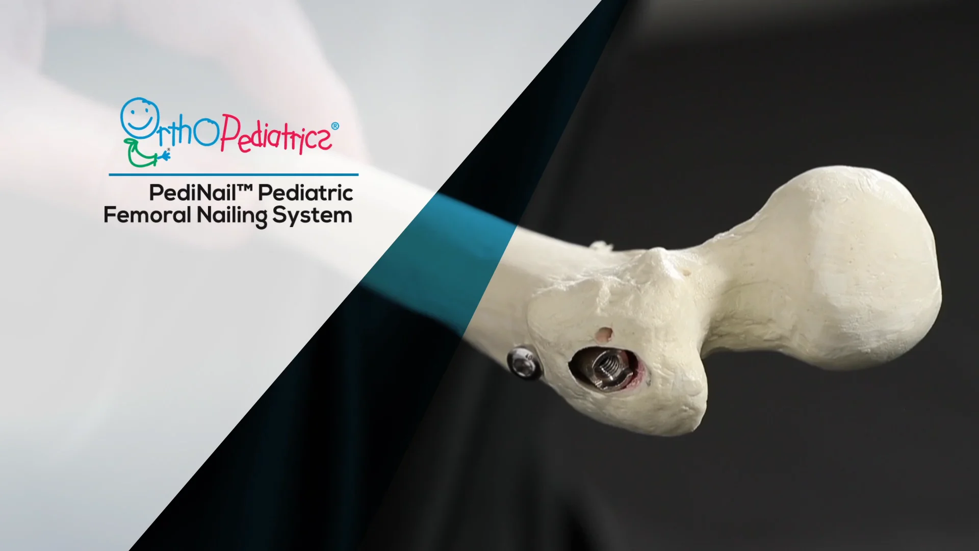 OrthoPediatrics PediNail - Pediatric Femoral Nailing System