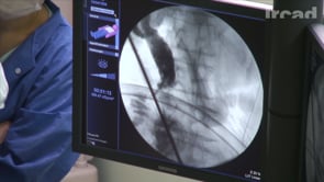 Colecistectomía y coledocoscopia laparoscópica para litiasis del ...