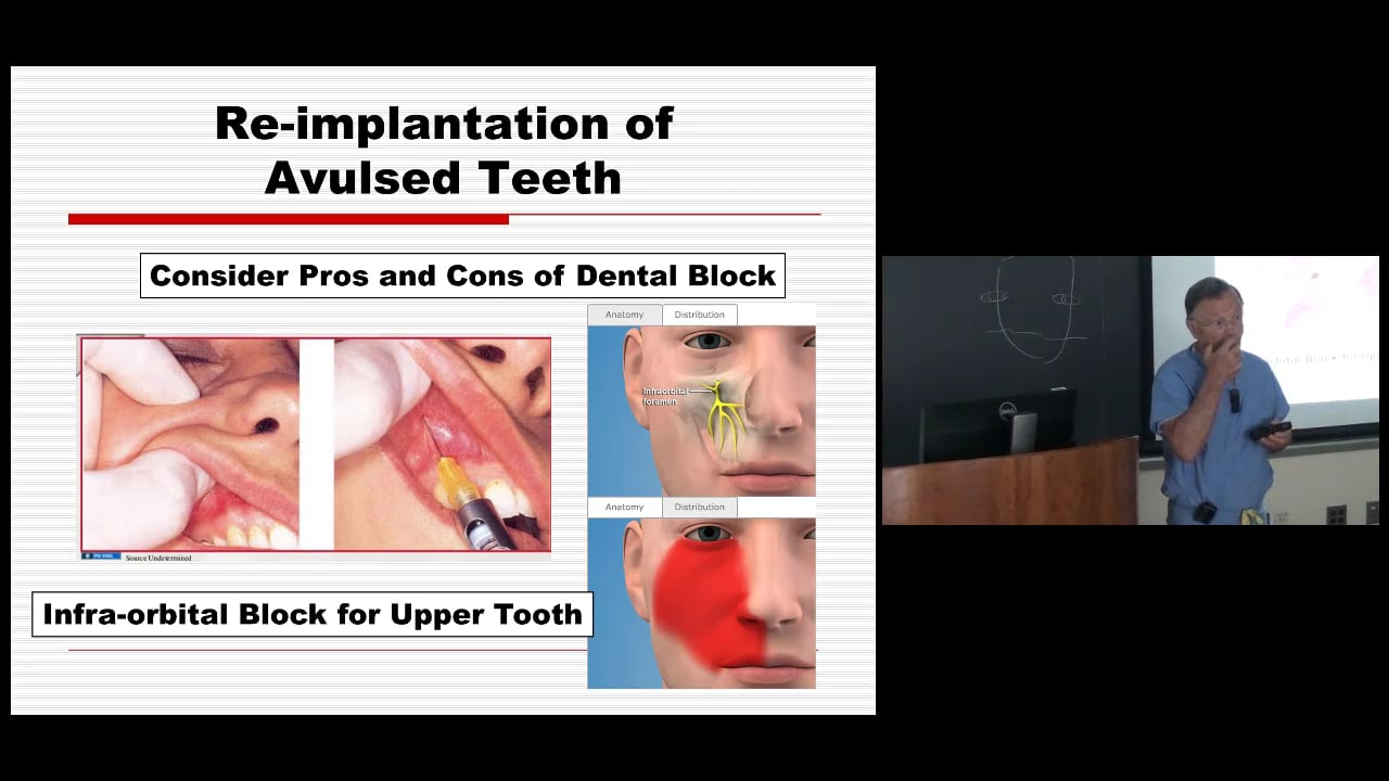 Reimplantation of Avulsed Teeth on Vimeo