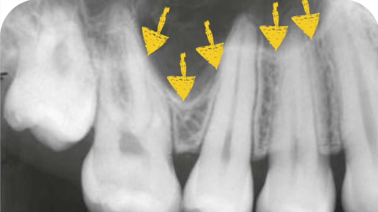 Management of Maxillary Sinus Perforation Following Tooth Extraction on ...