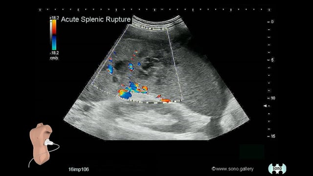 Ruptured Spleen Ultrasound