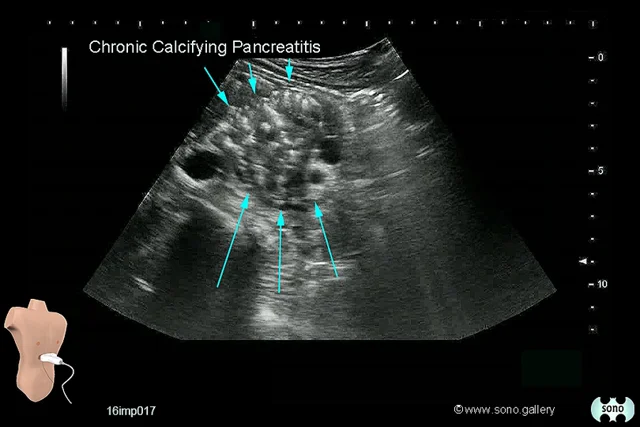 Phlegmonous Pancreatitis Ultrasound