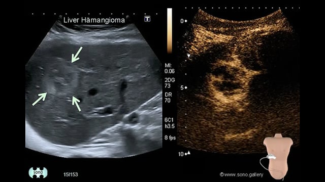 Focal Nodular Hyperplasia (FNH) - SONO.GALLERY