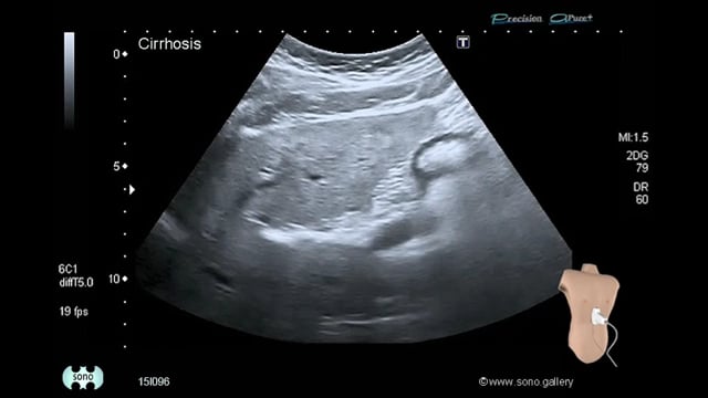 Hydronephrosis Grade 2/3, Ureteral Stent - SONO.GALLERY