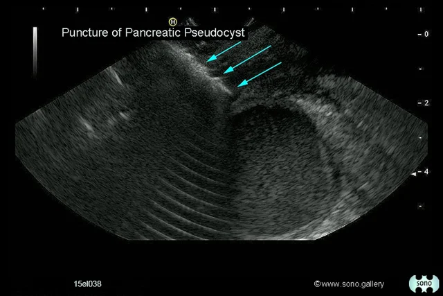 Pancreatic Pseudocyst Ultrasound
