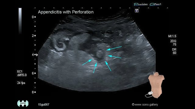 Subphrenic Abscess - SONO.GALLERY
