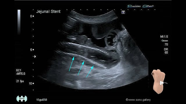 Hydronephrosis Grade 2/3, Ureteral Stent - SONO.GALLERY