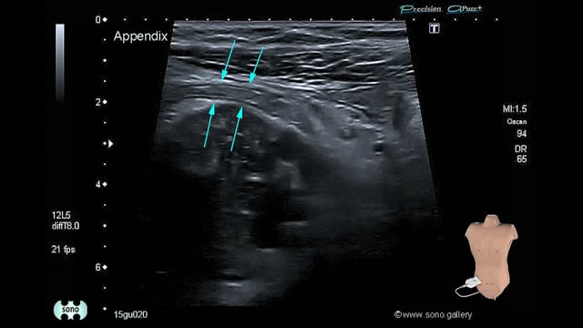 Normal Appendix - SONO.GALLERY