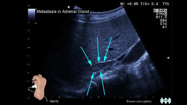 pancreatic cancer (proc. uncinatus) - SONO.GALLERY