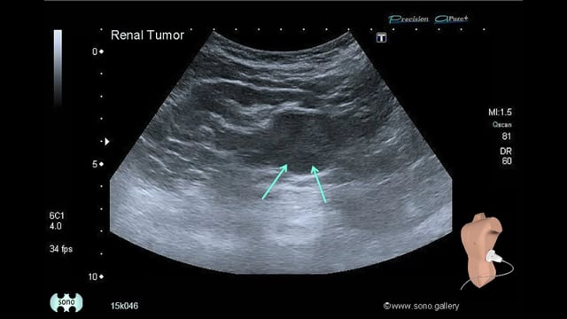 pancreatic cancer (proc. uncinatus) - SONO.GALLERY