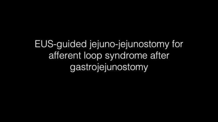 Jejunojejunostomy