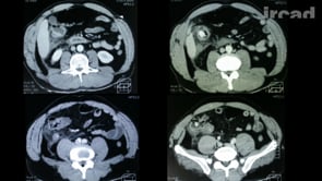 Laparoscopic retrocaecal appendectomy and disseminated peritonitis ...
