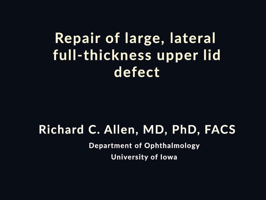 Repair of large, lateral full-thickness upper lid defect on Vimeo