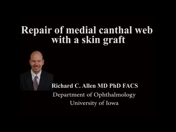 Repair of medial canthal web with a skin graft on Vimeo
