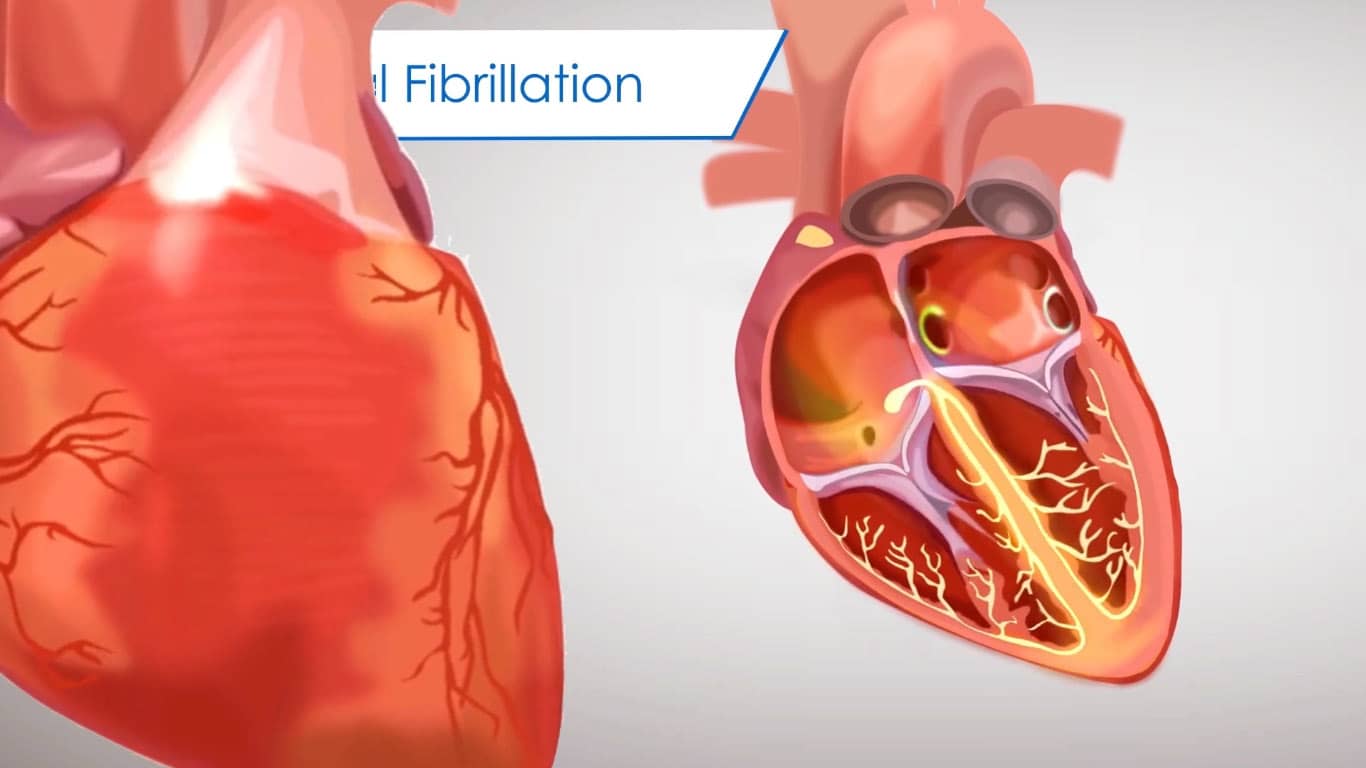 Atrial Fibrillation animation on Vimeo