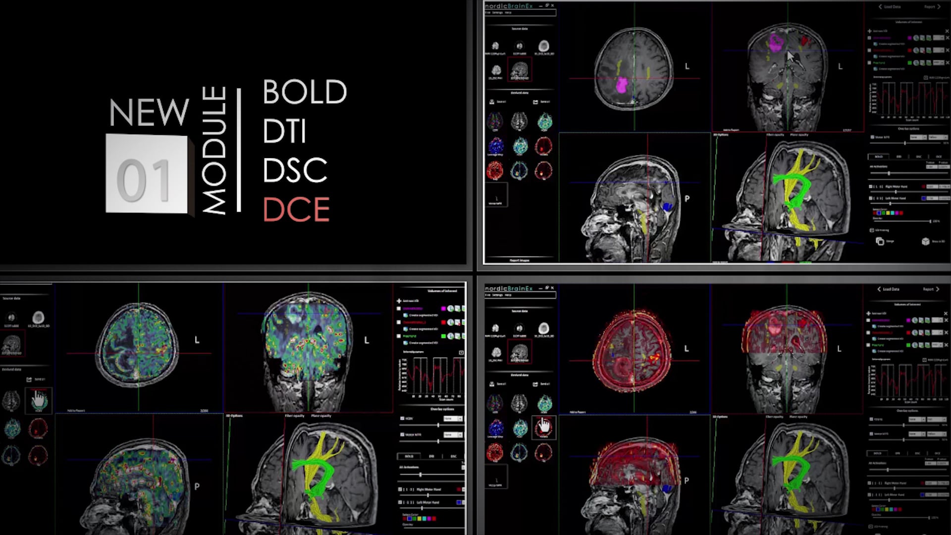 NordicNeuroLab nordicBrainEx now also with DCE module on Vimeo