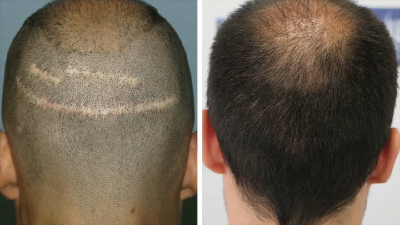 640 Grafts FUE Scar Revision by Dr. Juan Couto / FUEXPERT CLINIC on Vimeo