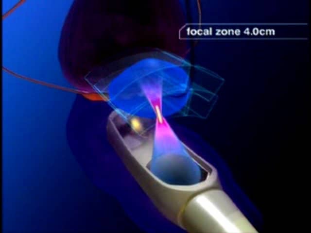 HIFU Animation on Vimeo